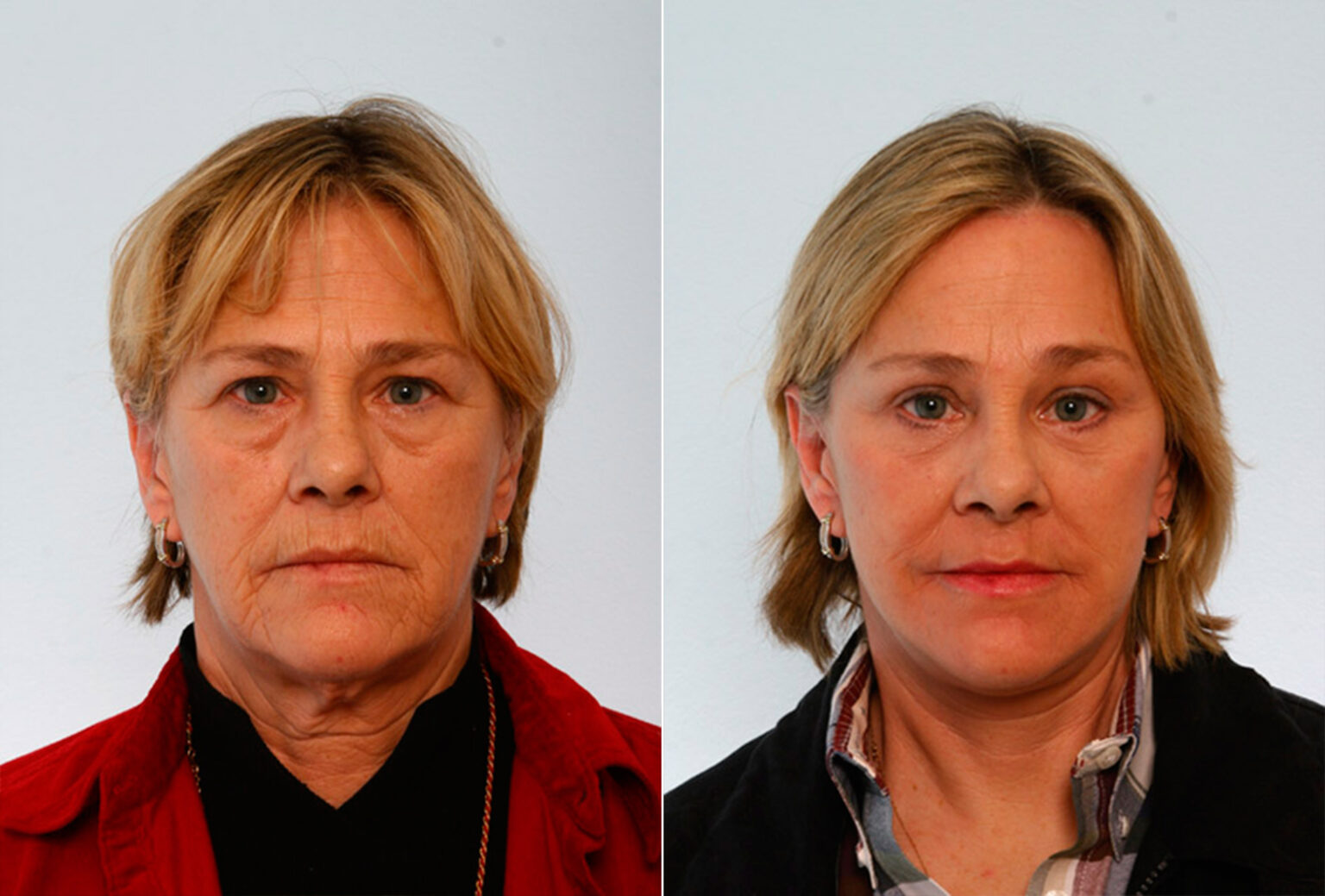 Expectations for Your Endoscopic Brow Lift Surgery Explained