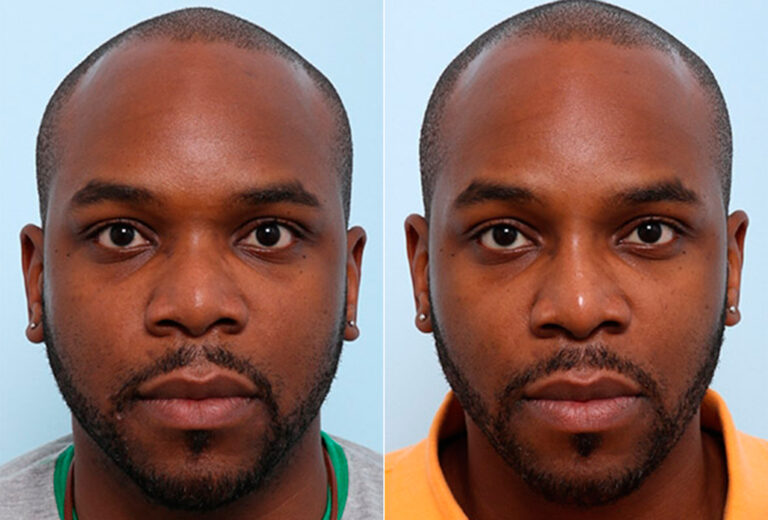 Buccal Fat Pad Removal Photos | Houston, Tx | Patient 27838