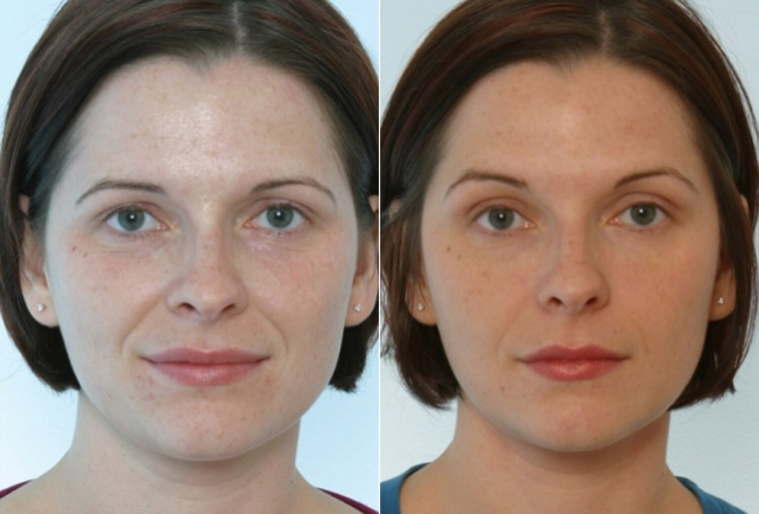 Fillers Before & After Photos | Dr. Vitenas