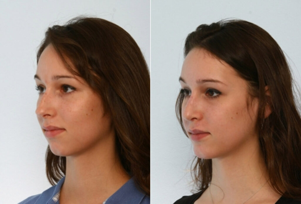 Nose Job / Rhinoplasty Photos | Houston, Tx | Patient 29490