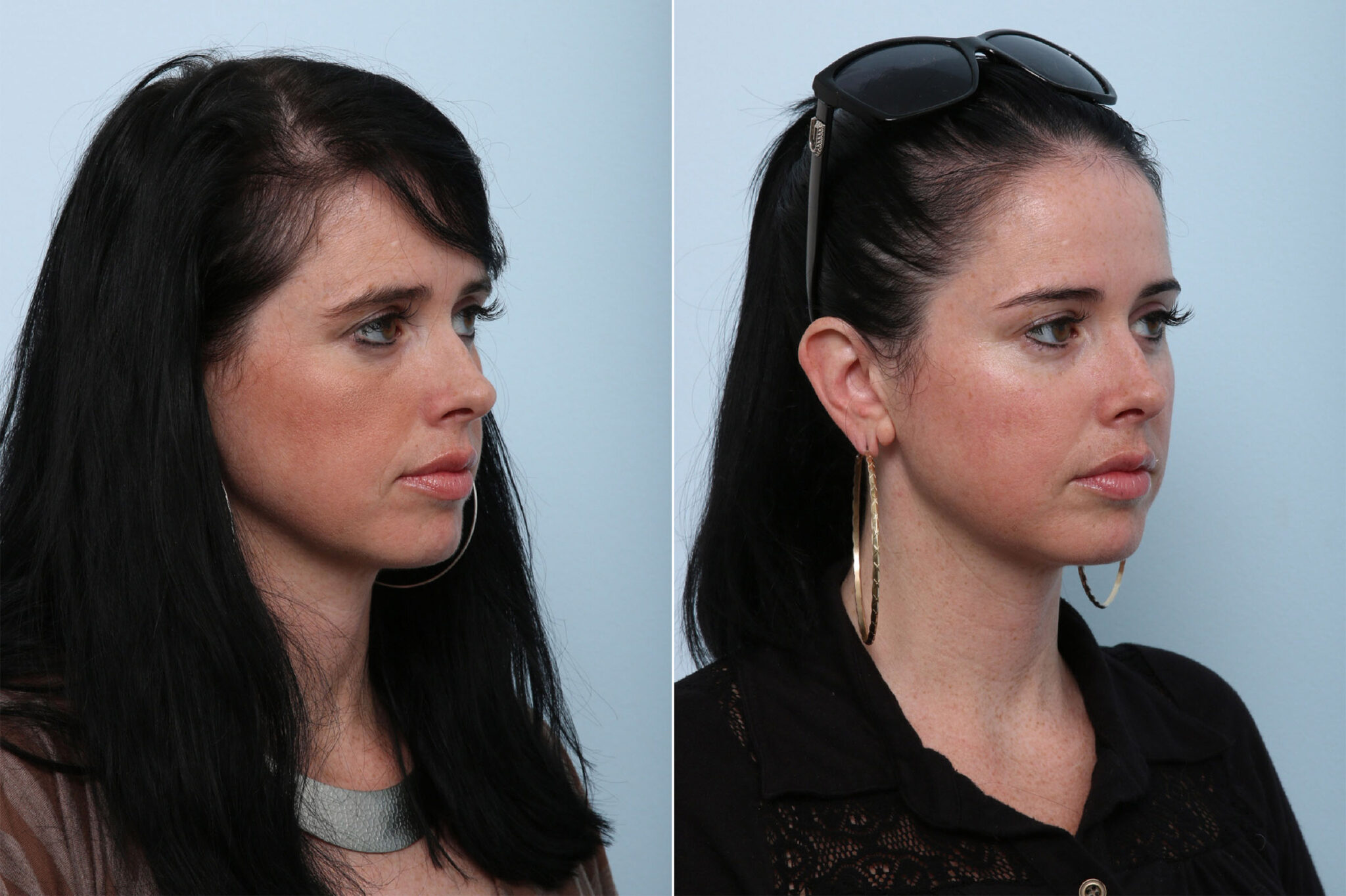 Juvederm Voluma XC Before & After Photos | Dr. Vitenas