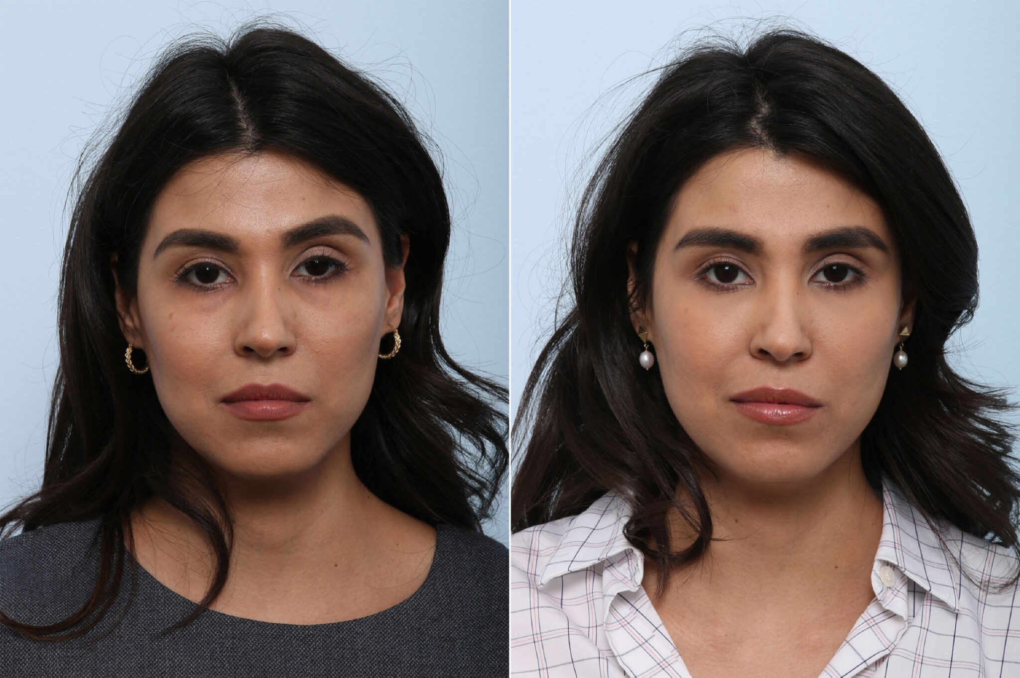 Juvederm Voluma XC Before & After Photos | Dr. Vitenas