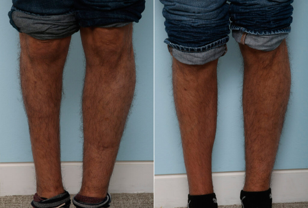 Calf Implants Before & After Photos | Dr. Vitenas