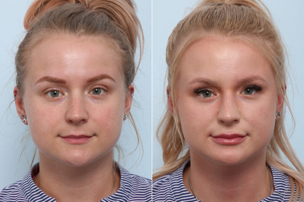 Lip Augmentation Before & After Photos | Dr. Vitenas | Page 2 of 2