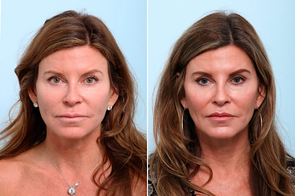 Surgical Lip Lift Houston, TX | Dr. Vitenas