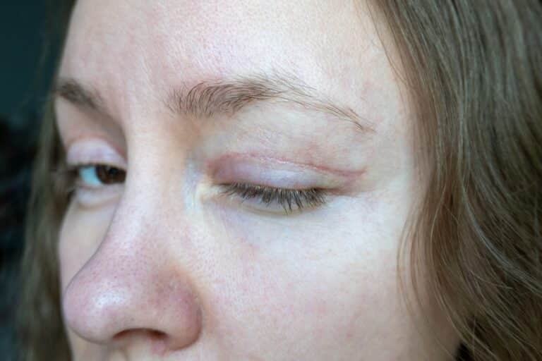 Tips for healing surgical scars after plastic surgery | Dr. Vitenas